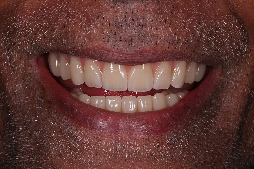 All on 4 Materials: What is Better? Zirconia, PMMA or Acrylic? - Dr ...